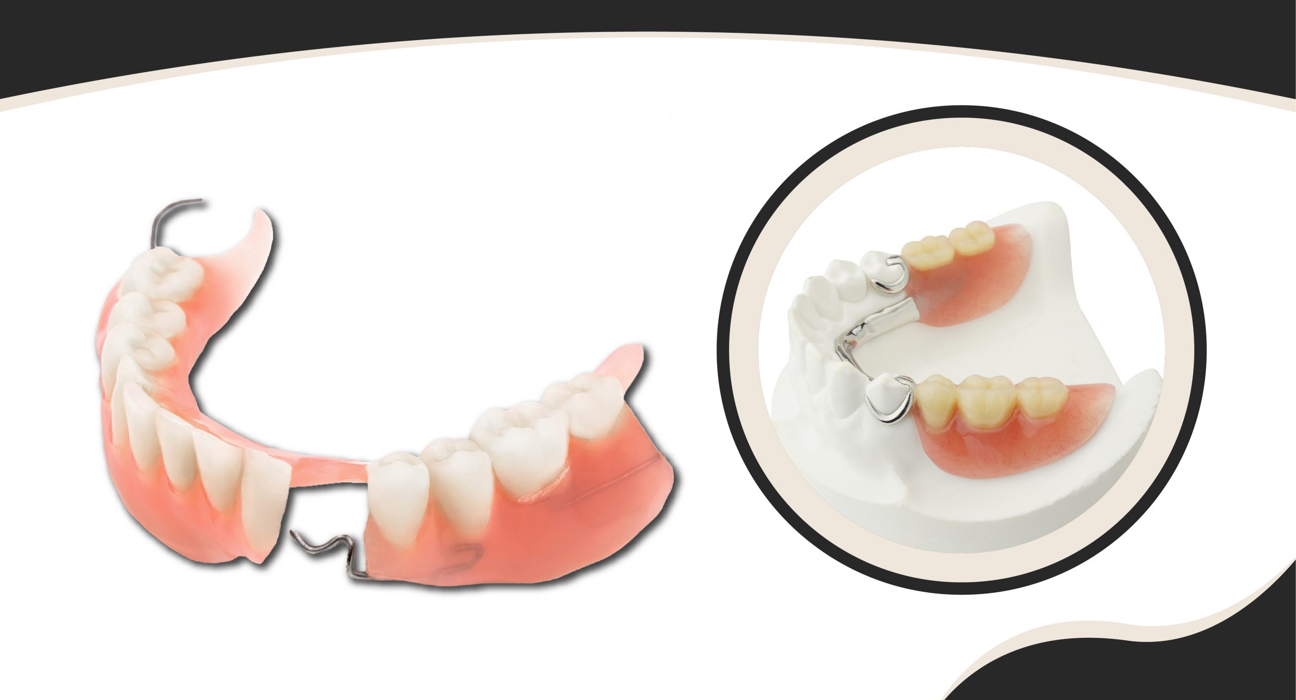 Partial Dentures - Fabricated for some missing natural teeth